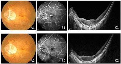 Frontiers | Efficacy of Conbercept in the Treatment of Choroidal Neovascularization Secondary to ...